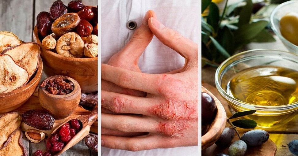 L’eczéma : causes, symptômes, diagnostic et traitement - NewsMAG